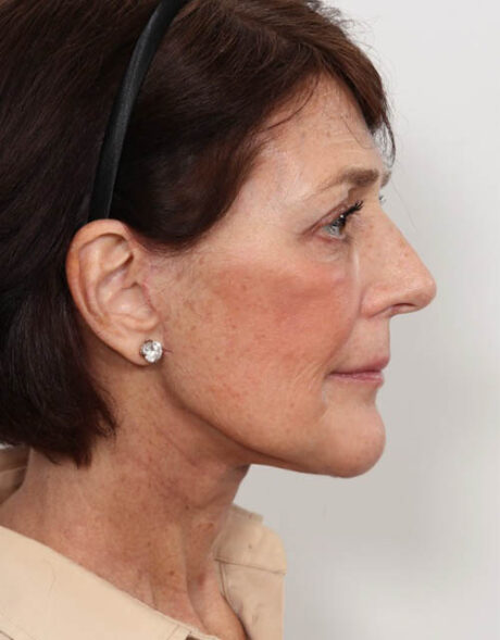 Facial Plastic Surgery New York City | Andrew Timberlake, MD, PhD